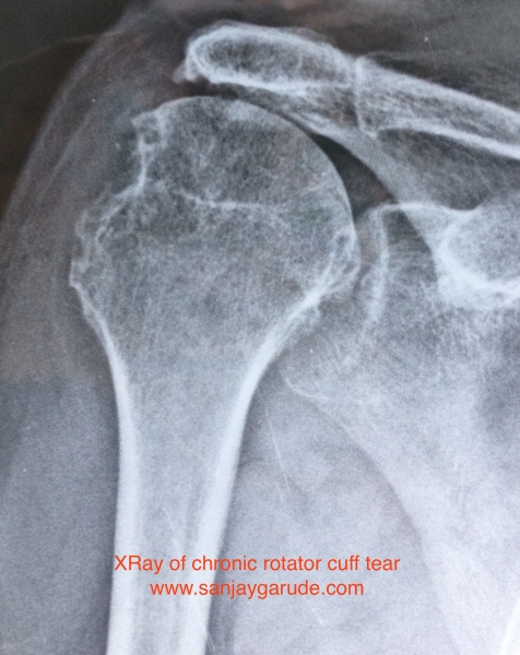 Shoulder Arthroplasty (Replacement) | Dr. Sanjay Garude